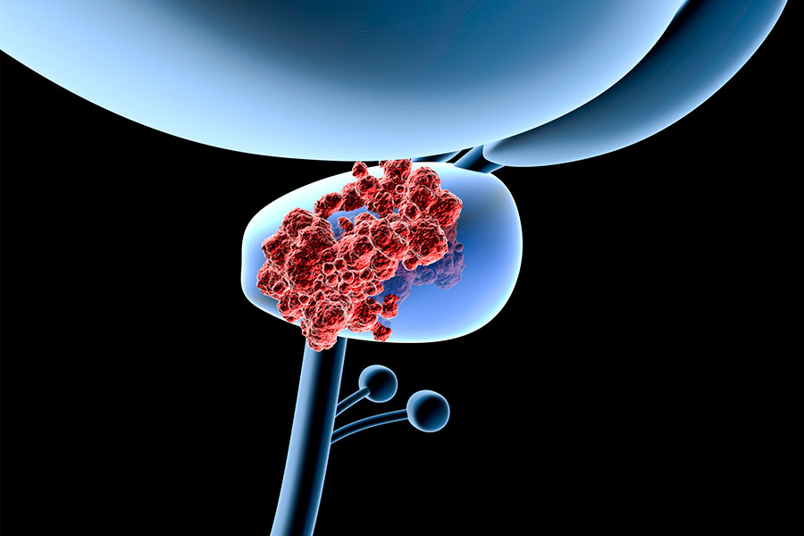 Cinco preguntas sobre el cáncer de próstata